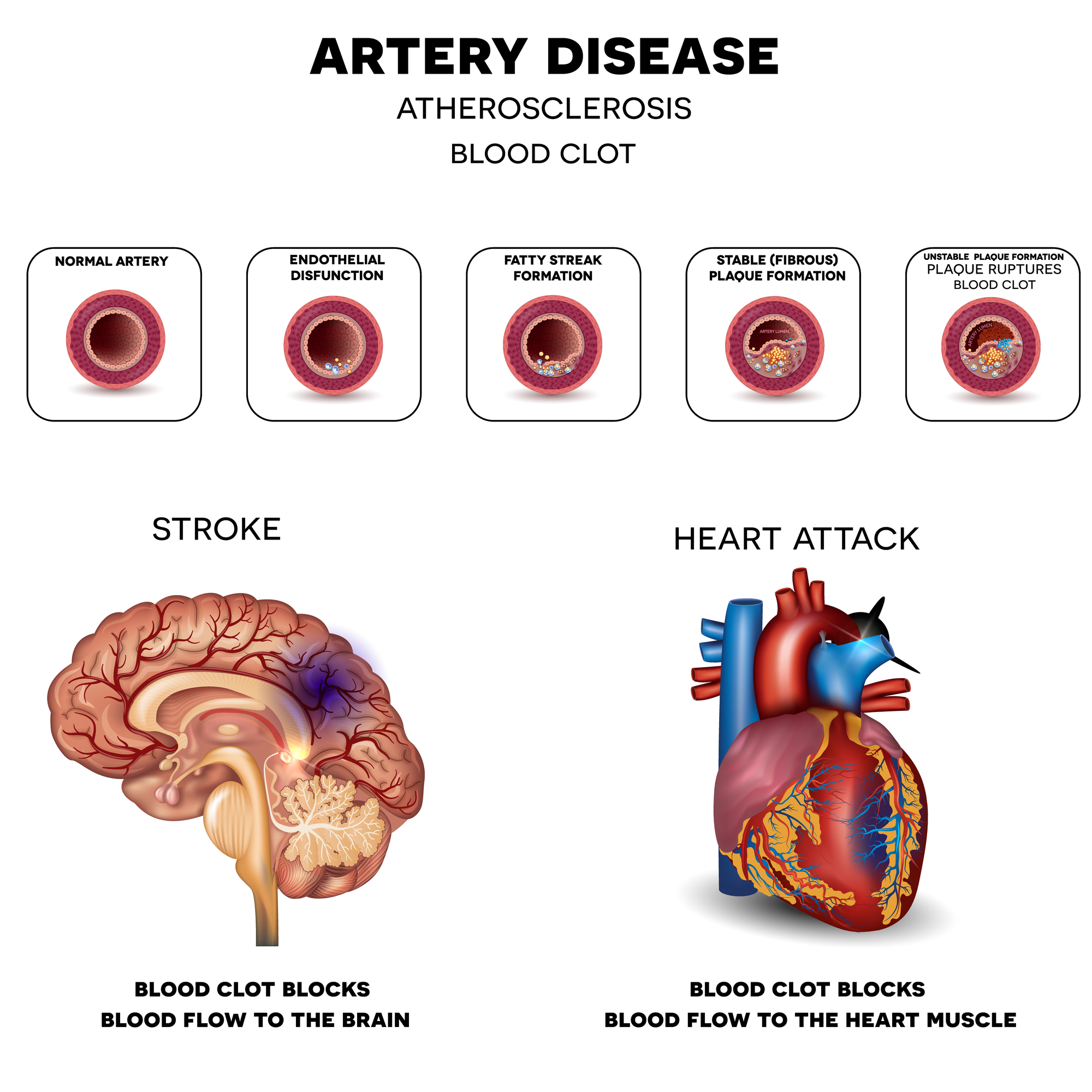Coronary Artery Calcium Scoring - Dr Sharon Goldberg